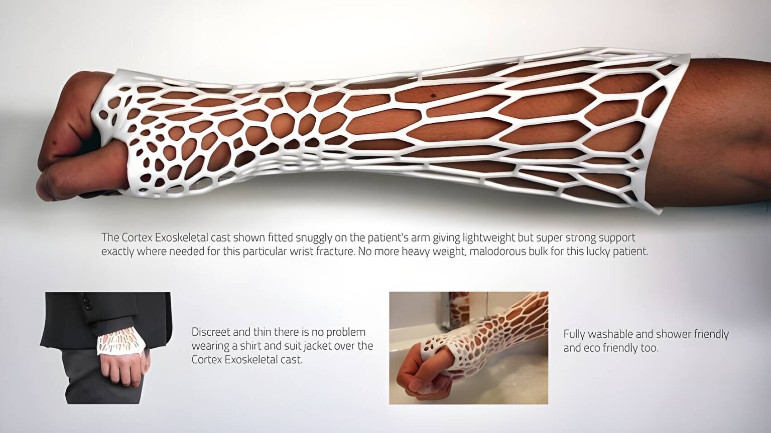 Adiós al yeso y las férulas, bienvenido Cortex - Blog ingeniería
